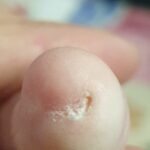 Retentissement fonctionnel dans le cadre d'une amputation distale du ...